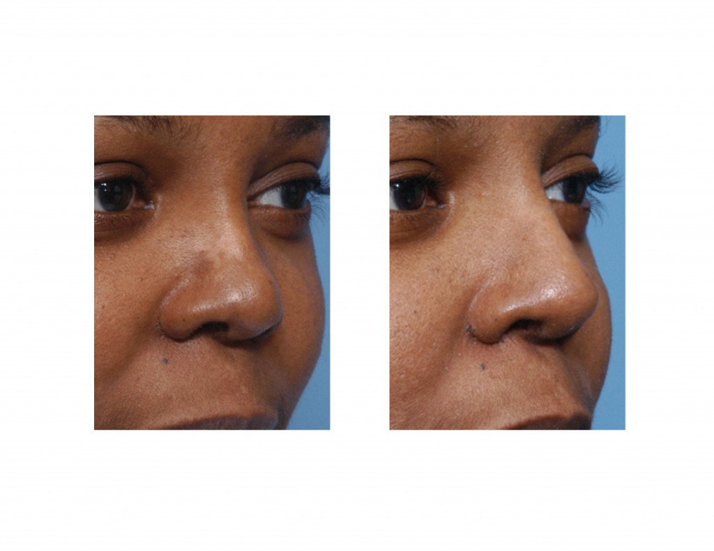 Rib Graft Revision Rhinoplasty results right oblique view Dr Barry ...