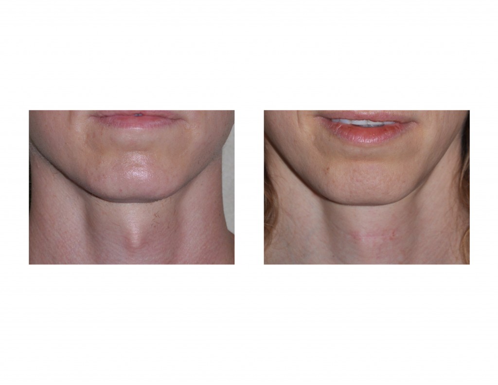 Case Study: Tracheal Shave for Neck Feminization - Explore Plastic Surgery