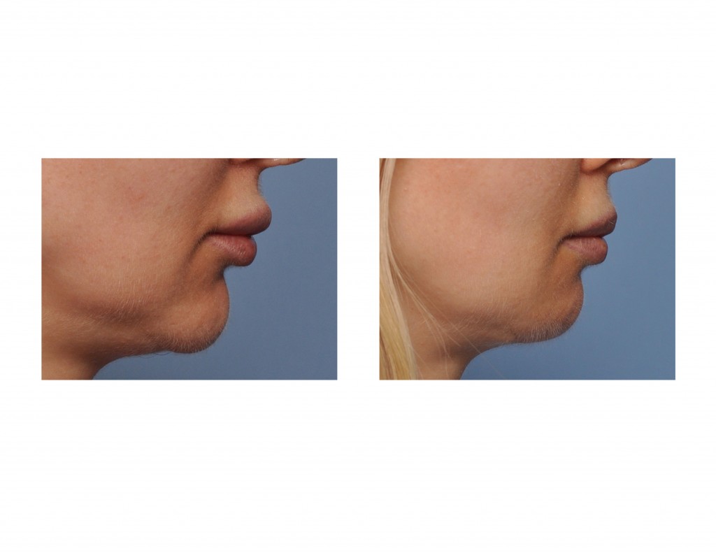Case Study: Vertical Chin Reduction by Submental Ostectomy - Explore ...
