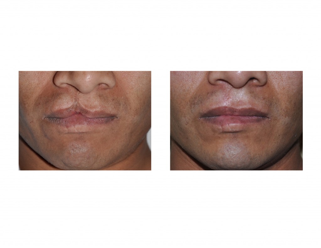 Case Study: Adult Primary Cleft Lip Repair - Explore Plastic Surgery