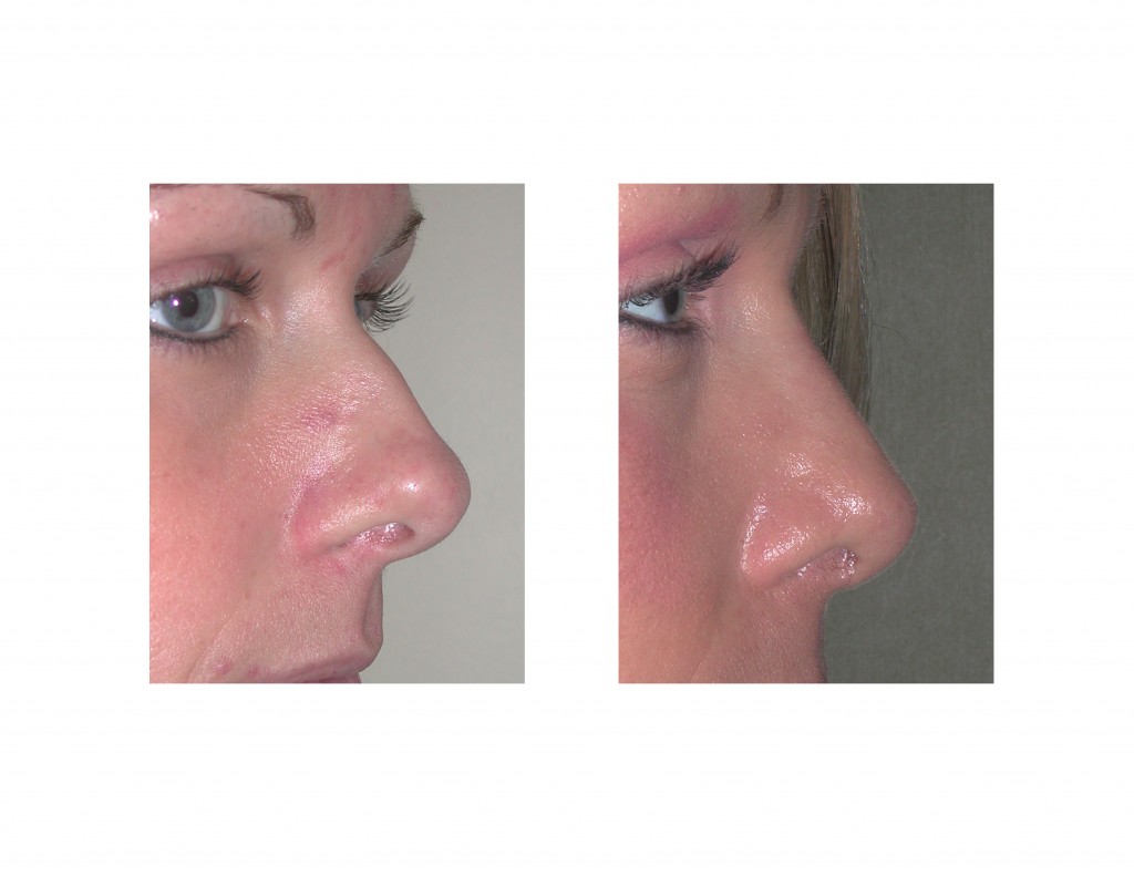 Case Study: Rhinoplasty for the Boxy Tip - Explore Plastic Surgery