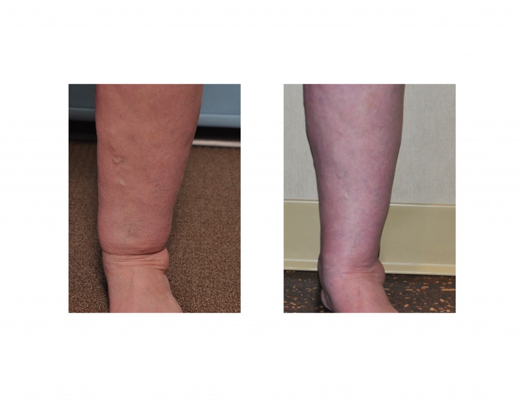 Cankle Liposuction Indianapolis Dr Barry Eppley - Explore Plastic Surgery