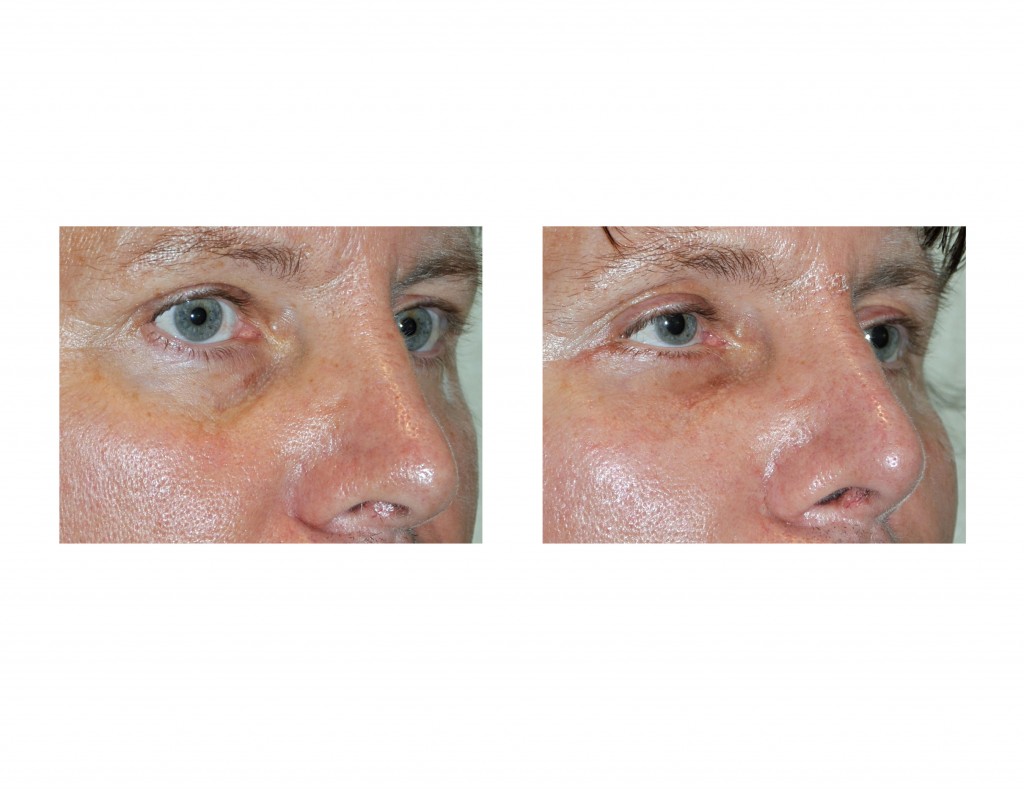 Case Study: Implant Augmentation of Lower Eyelid Hollows/Tear Troughs ...