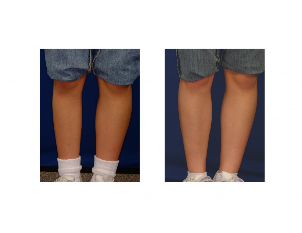 Case Study: Implant Augmentation in Calf Asymmetry in Clubfoot ...