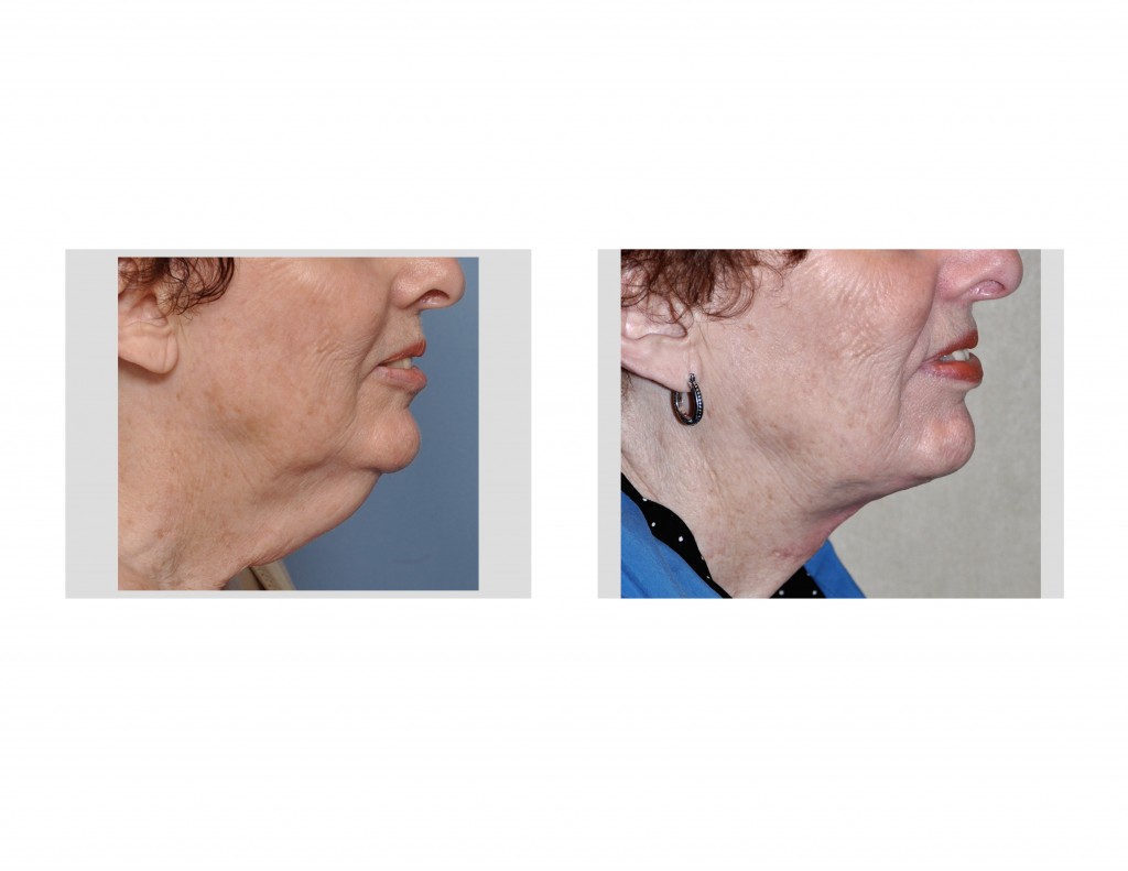 Case Study: The Direct Necklift For Neck Wattles In Women - Explore ...