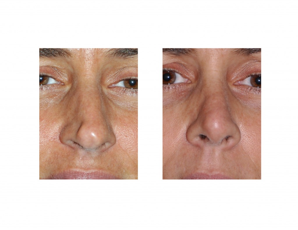 Case Study: Rhinoplasty Reduction of the Long Overprojected Nose ...