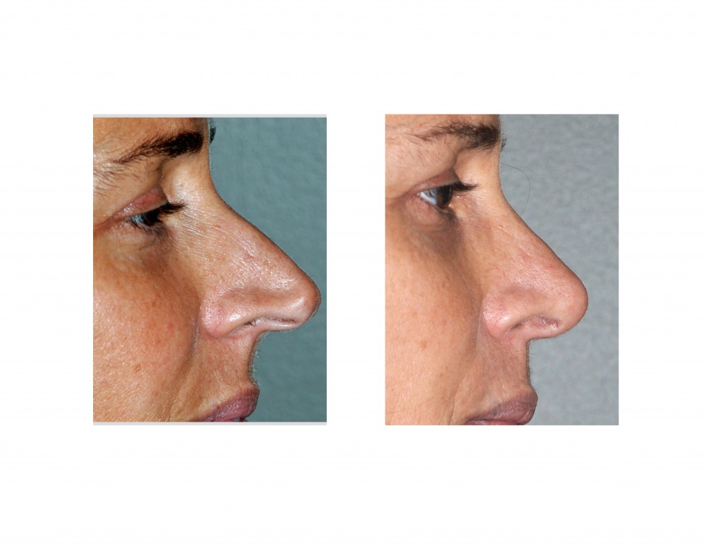 Case Study: Rhinoplasty Reduction of the Long Overprojected Nose ...