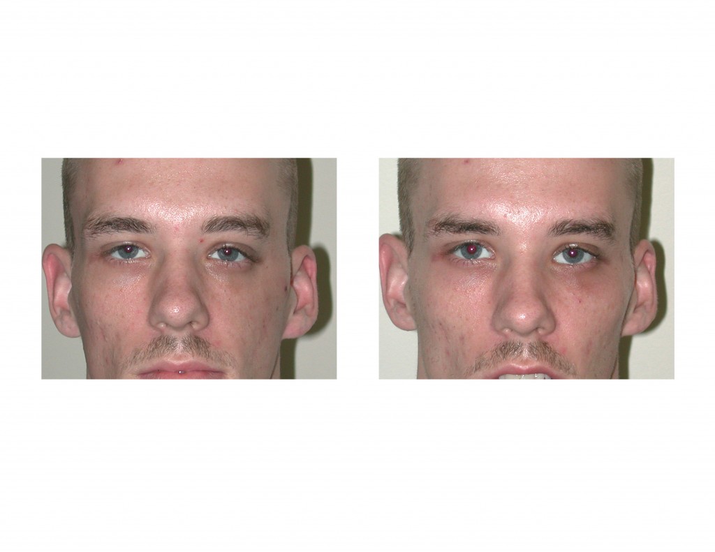 Traumatic Cheek Deformity Reconstruction front view Dr Barry Eppley ...