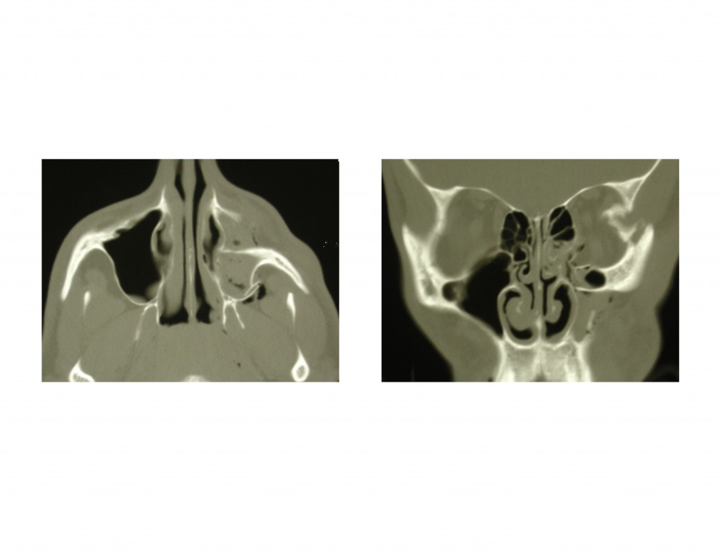 Case Study: Delayed Cheekbone Fracture Repair - Explore Plastic Surgery