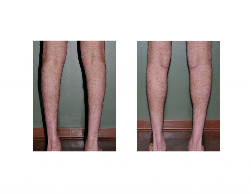 Case Study: Calf Implants in Bilateral Clubfeet - Explore Plastic Surgery