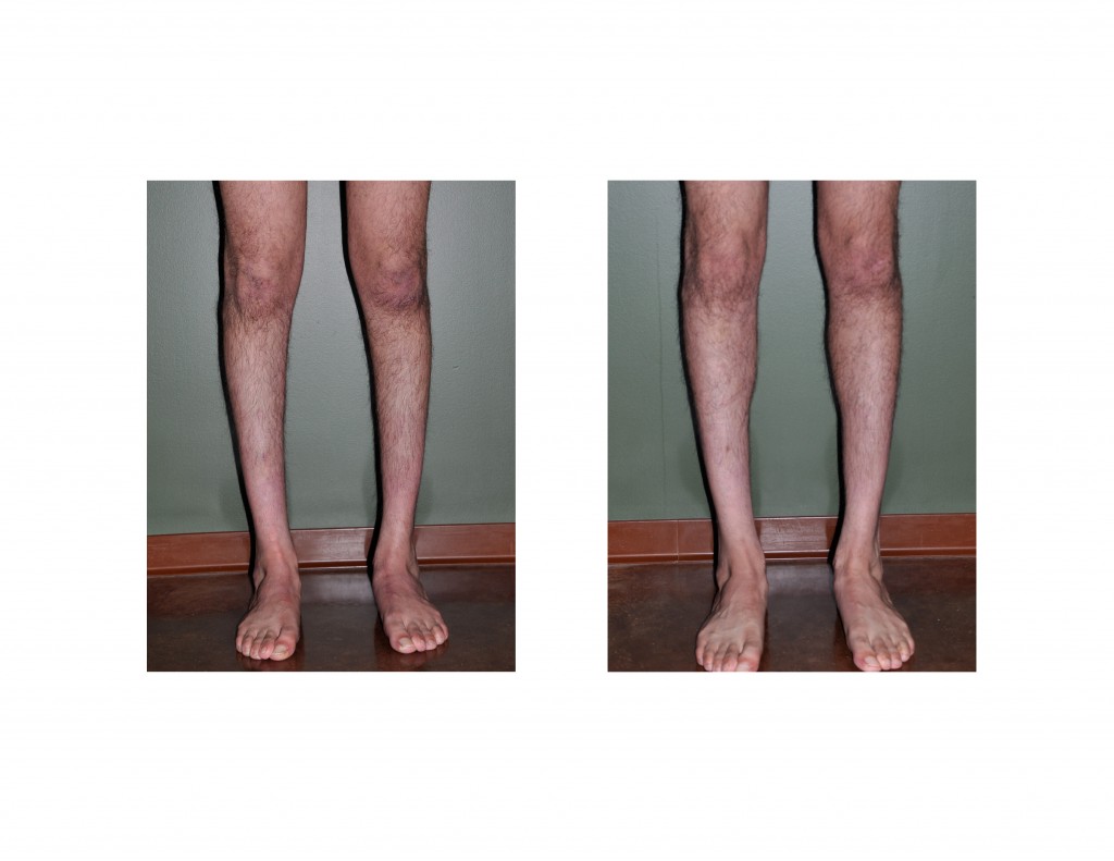 Case Study: Calf Implants in Bilateral Clubfeet - Explore Plastic Surgery