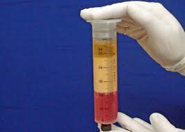 Fat Graft Decanting Dr Barry Eppley Indianapolis - Explore Plastic Surgery