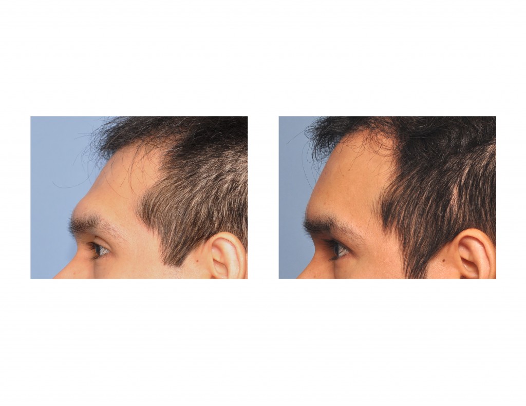 Case Study: Forehead Augmentation for Correction of Pseudo Brow ...