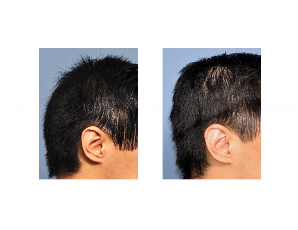 Case Study: Flat Back of the Head Correction by Augmentation ...