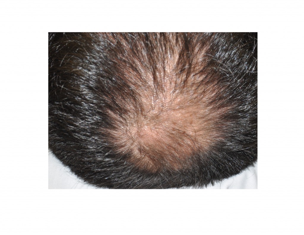 Case Study: Forehead Augmentation for Correction of Pseudo Brow ...