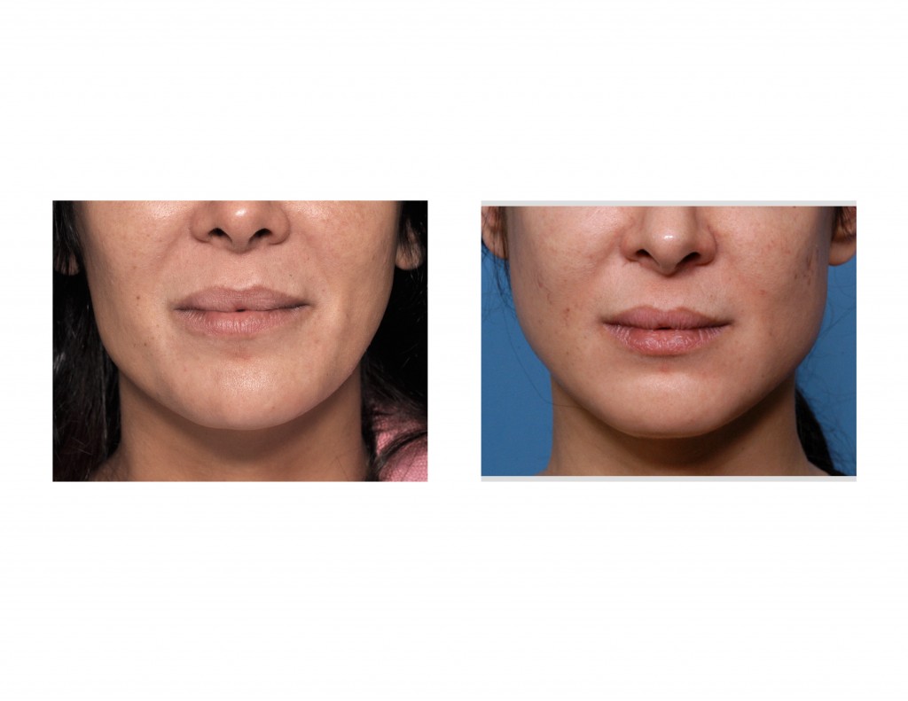 Case Study: Jaw Angle Augmentation in Facial Asymmetry Correction ... Case Study: Jaw Angle Augmentation in Facial Asymmetry Correction ...