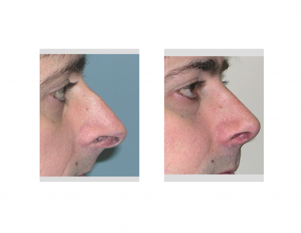 Case Study: Rhinoplasty for the Ultra-Projecting Nose - Explore Plastic ...