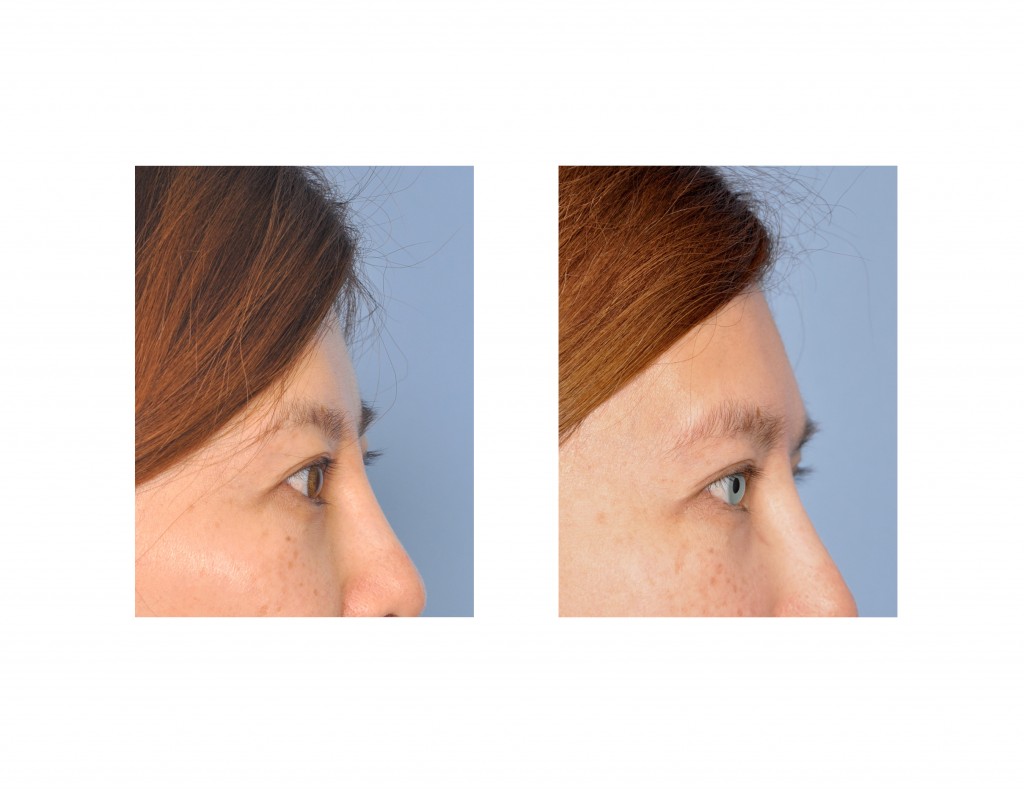 Female Forehead Augmentation result side view Dr Barry Eppley ...