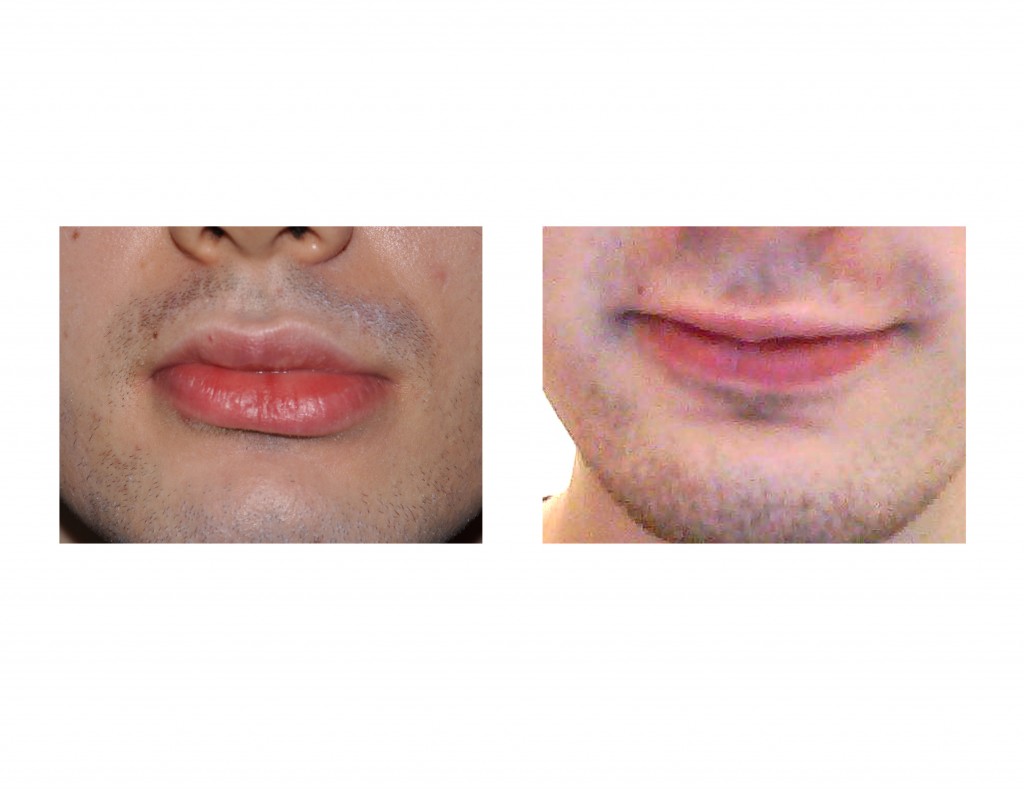 Case Study: Lip Advancement for Lip Asymmetry - Explore Plastic Surgery