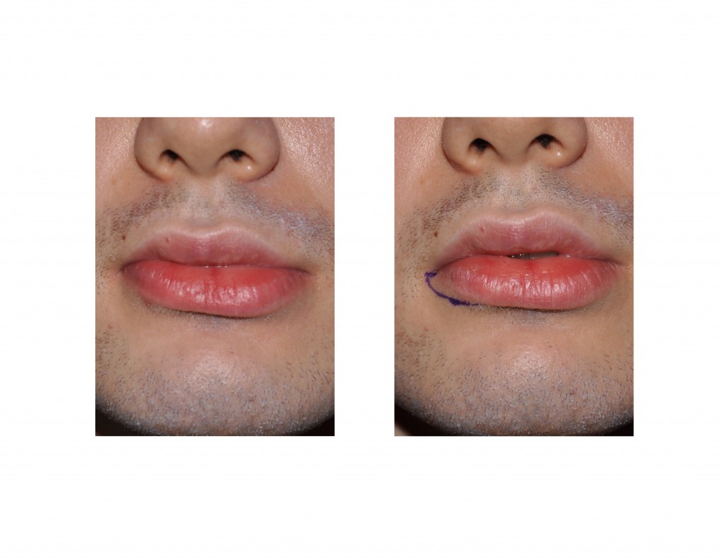 Partial Lower Lip Advancement for Asymmetry Dr Barry Eppley ...