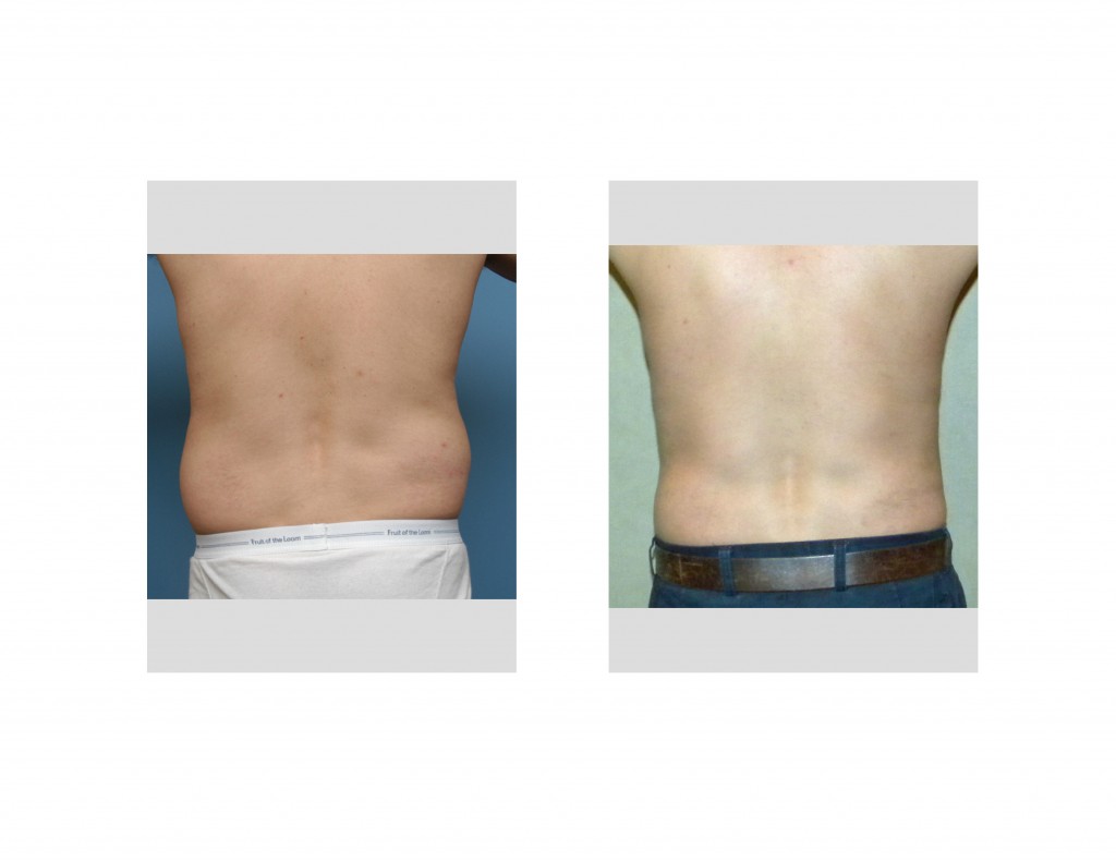 Case Study: Realistic Male Abdominal and Love Handle Liposuction ...