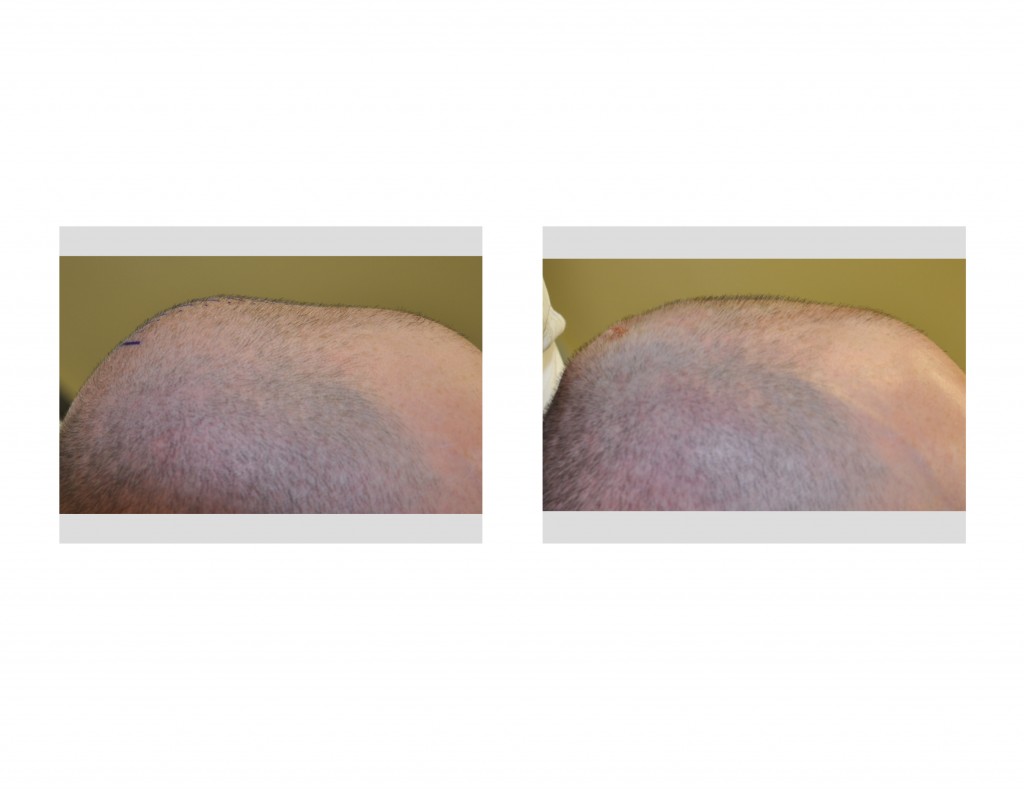 Case Study: Sagittal Ridge Reduction Skull Reshaping Surgery - Explore ...