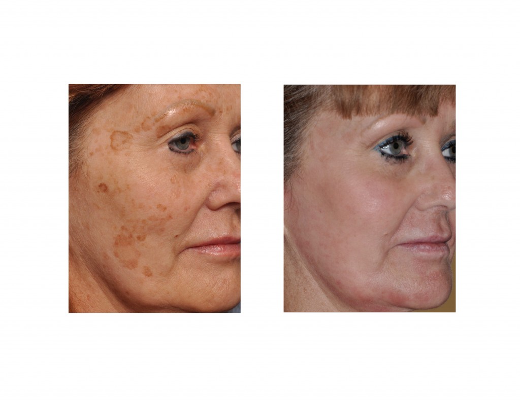 Case Study: Laser Resurfacing for Facial Brown Spots - Explore Plastic ...