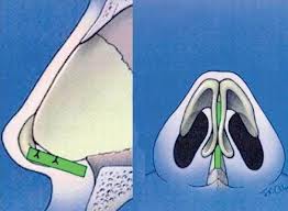 Columellar Strut in Rhinopasty Dr Barry Eppley Indianapolis - Explore ...