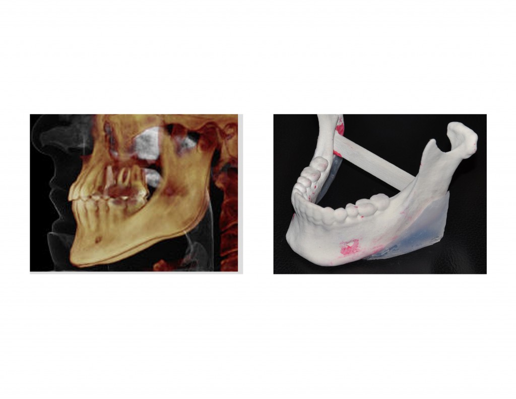 Custom Vertical Lengthening Jaw Angle Implant desigtn Dr Barry Eppley ...