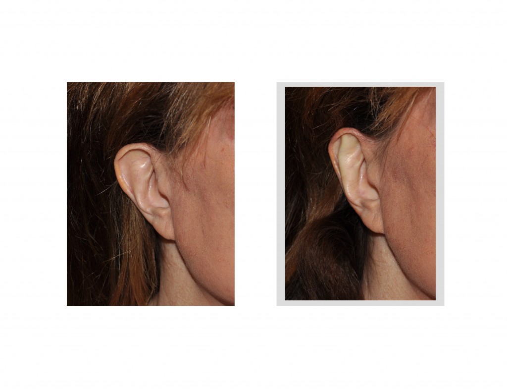 Case Study: A Mini-Otoplasty for Minor Ear Reshaping - Explore Plastic ...