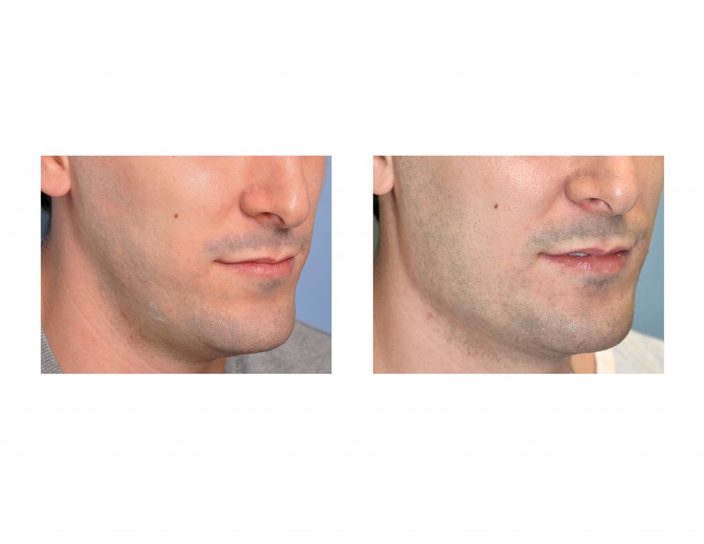 jaw angle implants Archives