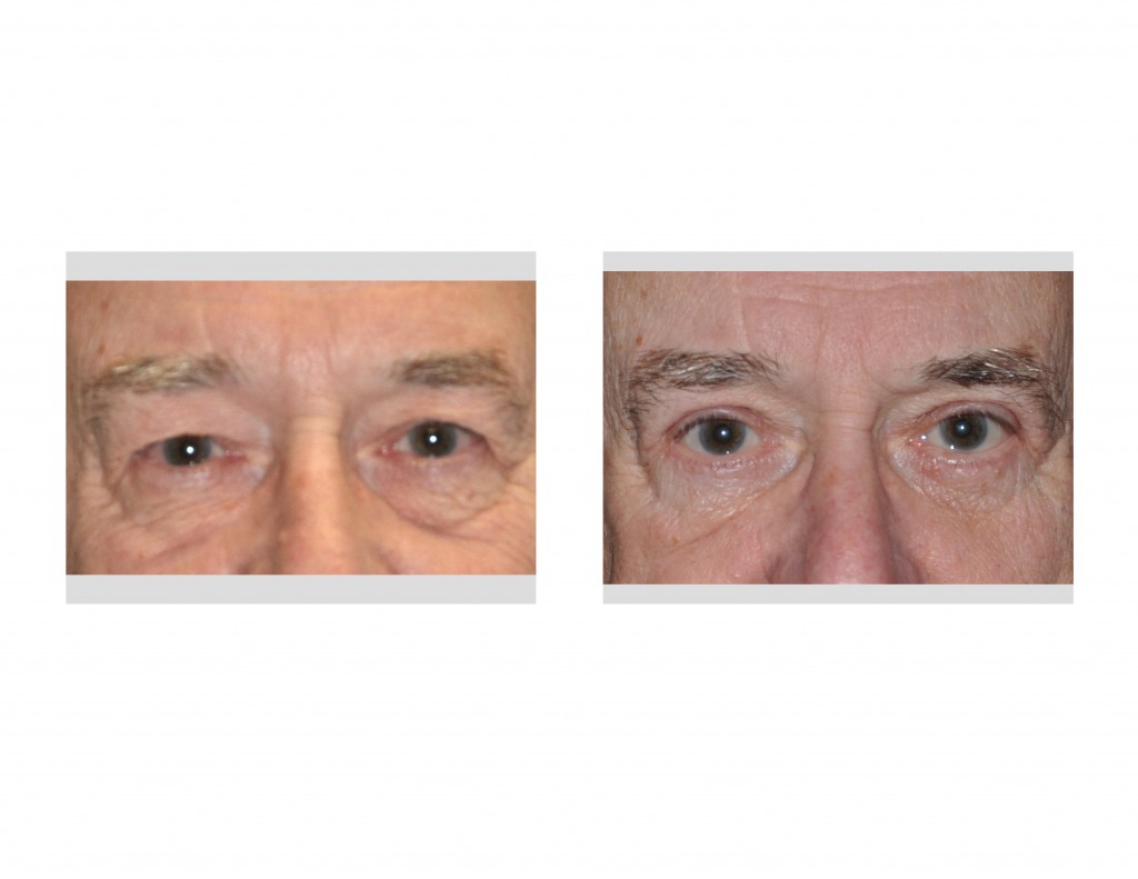 Case Study: Eyelid Lifts (Blepharoplasty) in the Older Male - Explore ...