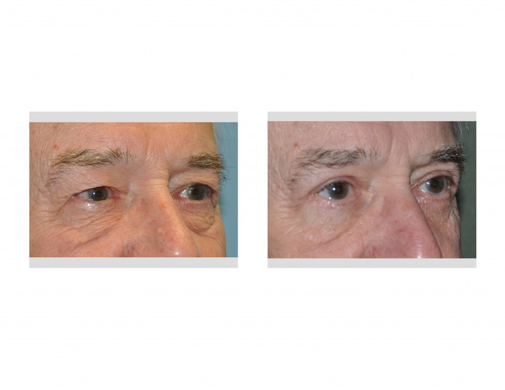 Case Study: Eyelid Lifts (Blepharoplasty) in the Older Male - Explore ...