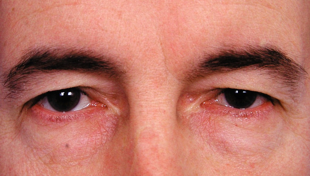 Older Male Eyelid hooding Dr Barry Eppley Indianapolis - Explore ...