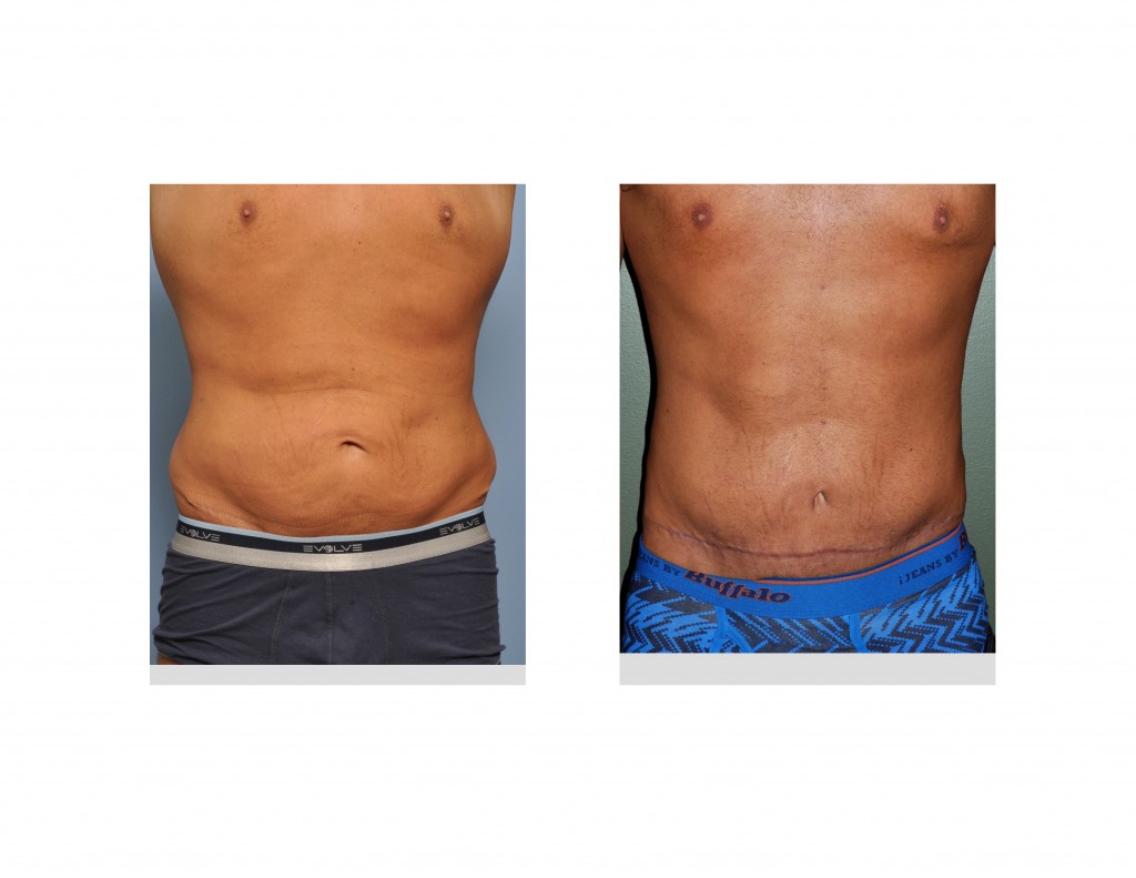 Case Study: Male Tummy Tuck after Weight Loss - Explore Plastic Surgery