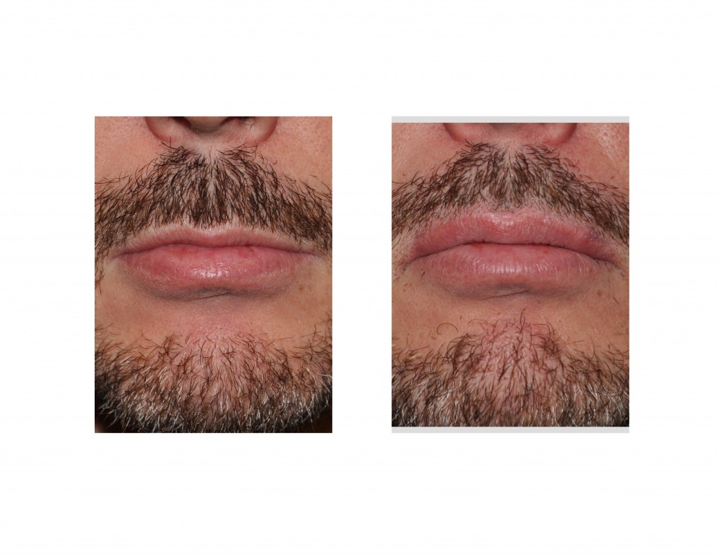 Case Study: Upper Lip Advancement in a Man - Explore Plastic Surgery