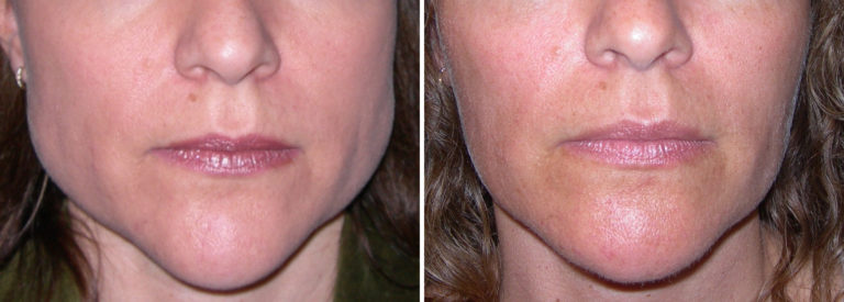 Botox Injections Into The Masseter (Jaw) Muscle - Explore Plastic Surgery