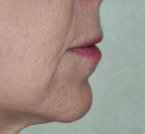 Labiomental Fold Augmentation Dr Barry Eppley Indianapolis - Explore ...