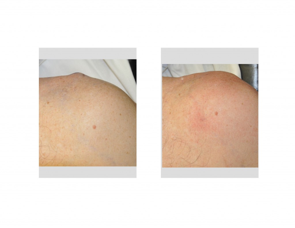 Fat Injections for Bony Shoulders (Deltoid Augmentation) Dr Barry ...