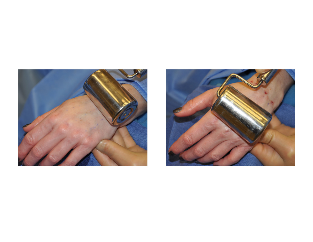 Hand Rolling of Fat Injections Dr Barry Eppley Indianapolis - Explore ...