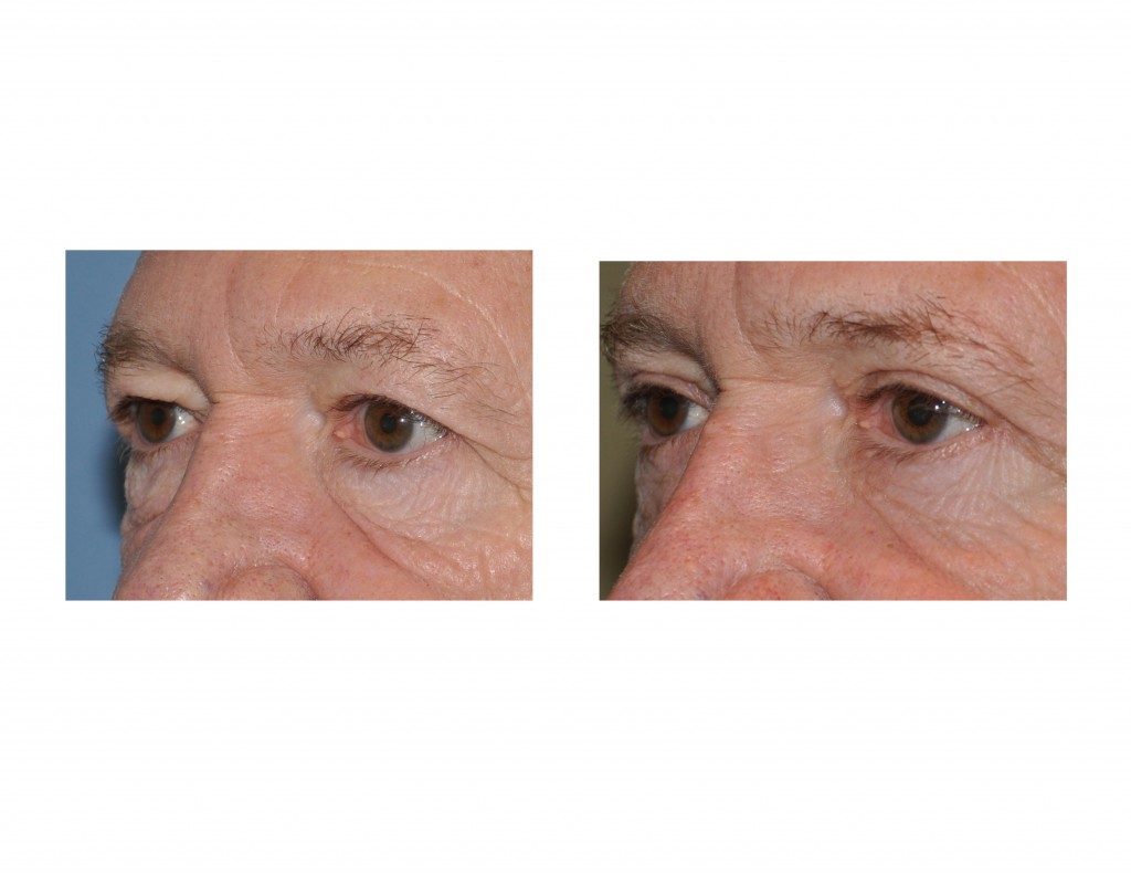 Lateral Canthopexy vs Canthoplasty - Implications for Eye Shape ...