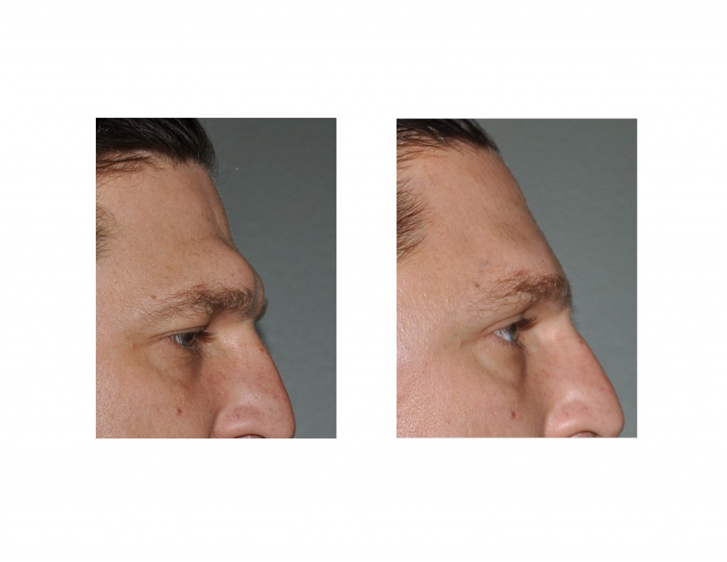 Technical Strategies - Brow Bone Reduction with Mid Forehead Nerve ...
