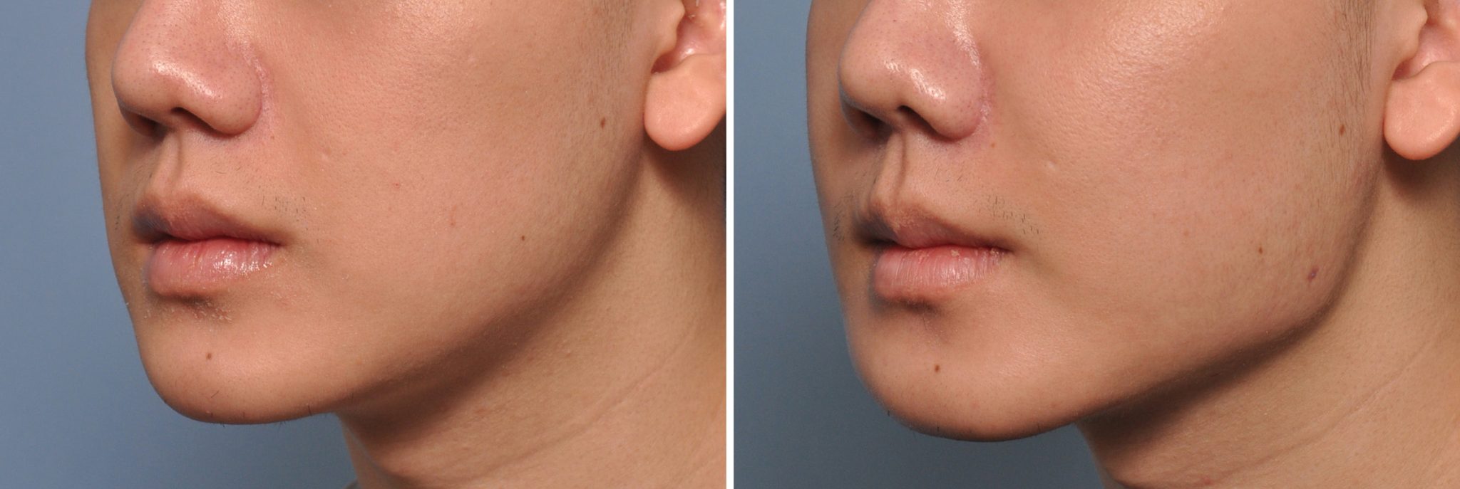 male jaw angle implants result oblique view Dr Barry Eppley ...