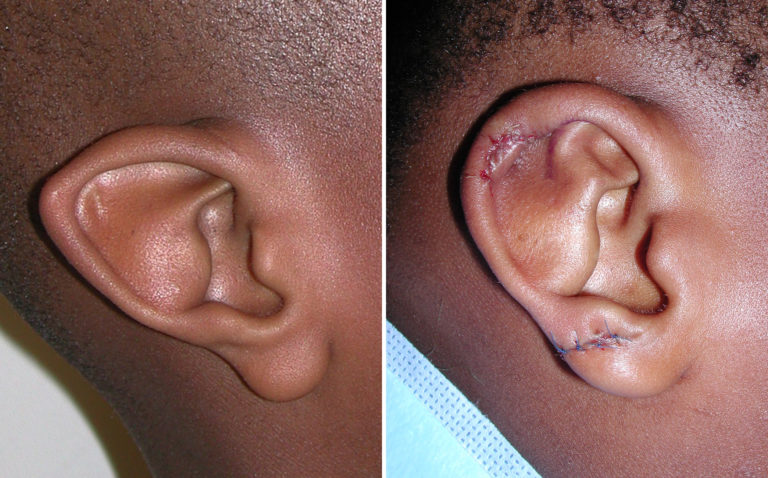 Simultaneous Stahl's Ear and Constricted Ear Corrections - Explore ...