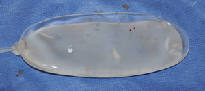 Scalp Tissue Expander Dr Barry Eppley Indianapolis - Explore Plastic ...