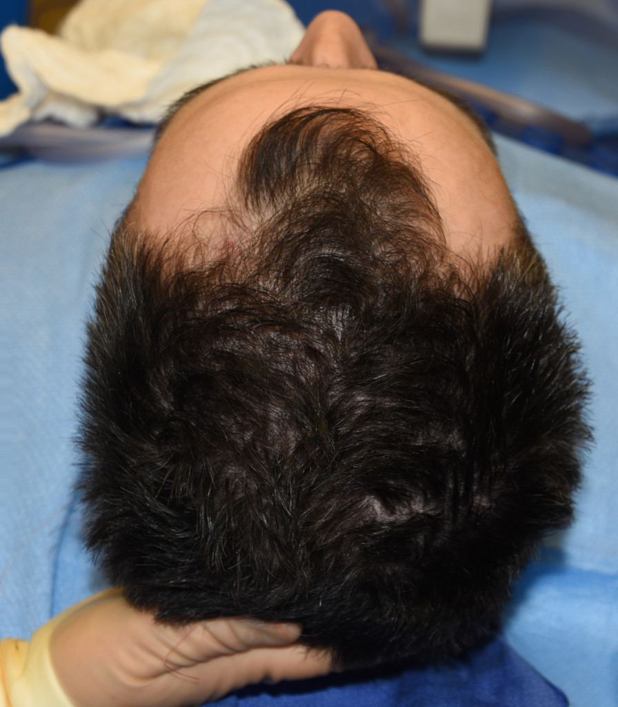 Technical Strategies - Minimal Incision Temporal Reduction Technique ...