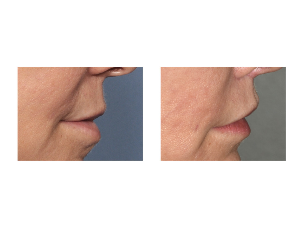 Plastic Surgery Case Study - Female Subnasal Lip Lift - Explore Plastic ...