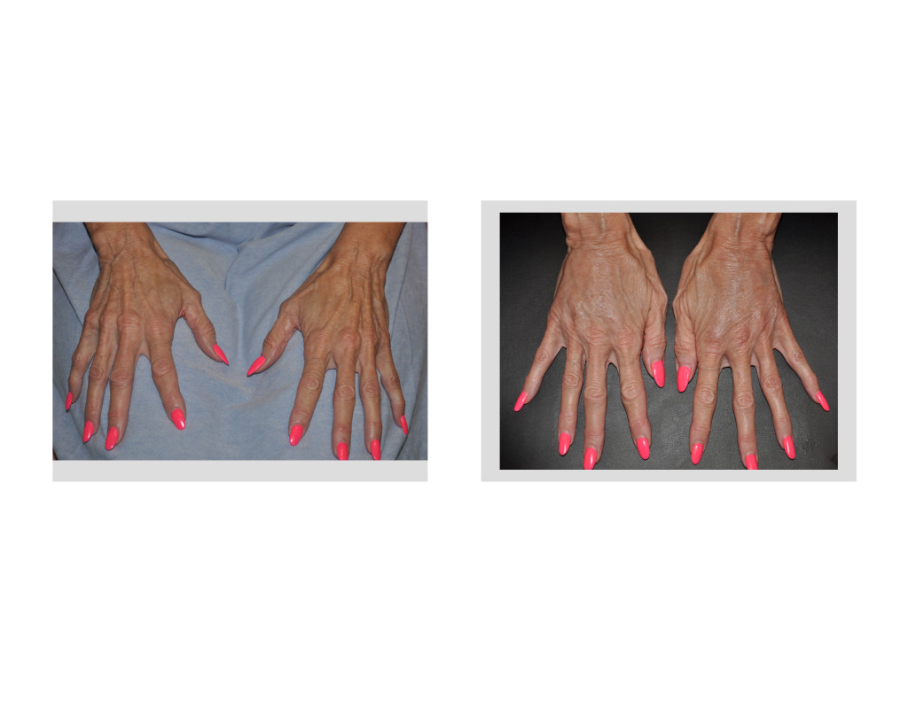 Hand Rejuvenation by Fat Injections - Explore Plastic Surgery