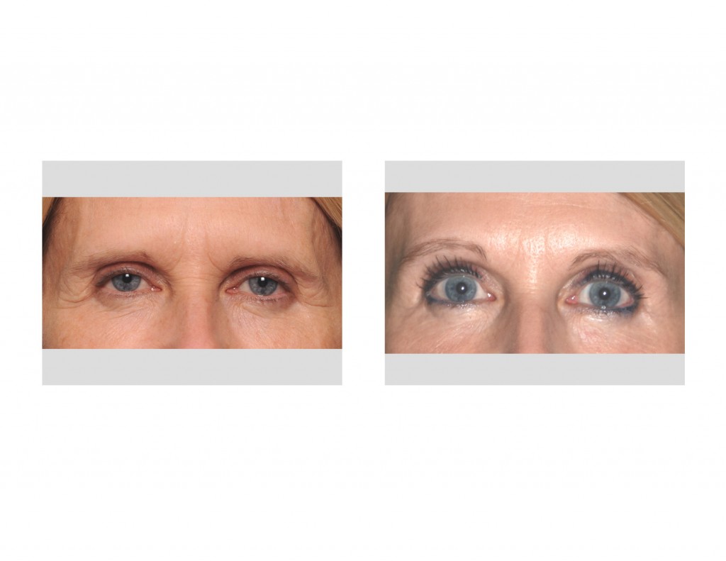 The Transcutaneous Browlift - A Direct Brow Reshaping Method - Explore ...