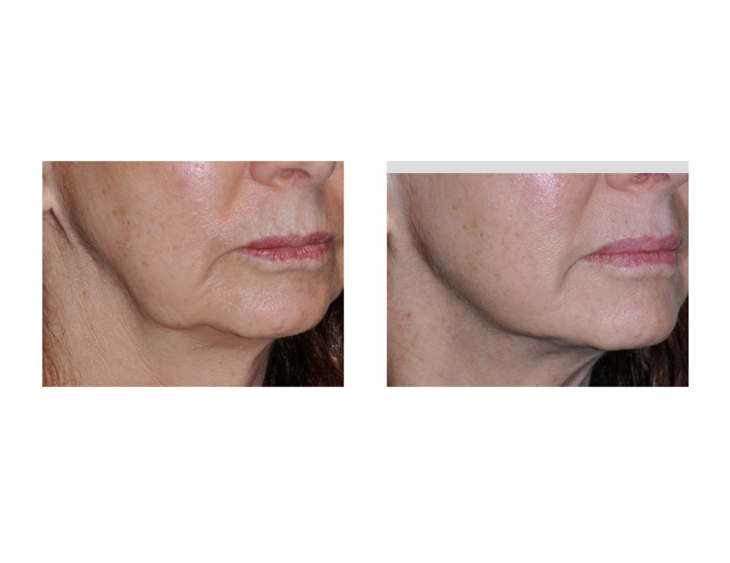 Kybella Injections for Jowl Reduction - Explore Plastic Surgery